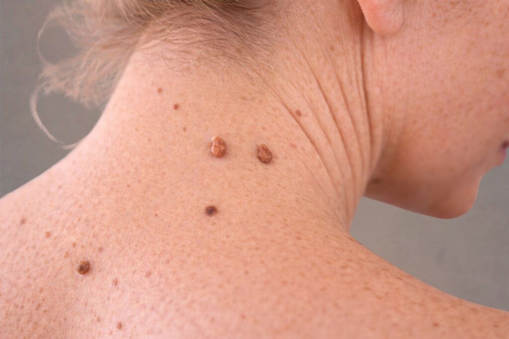 Skin Tags – Causes and Prevention | Epiderma